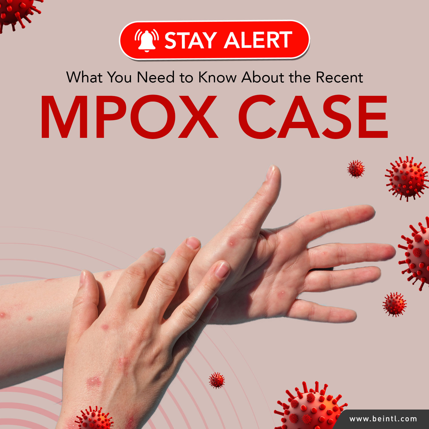 STAY ALERT: What You Need to Know About The Recent Mpox Case in ...